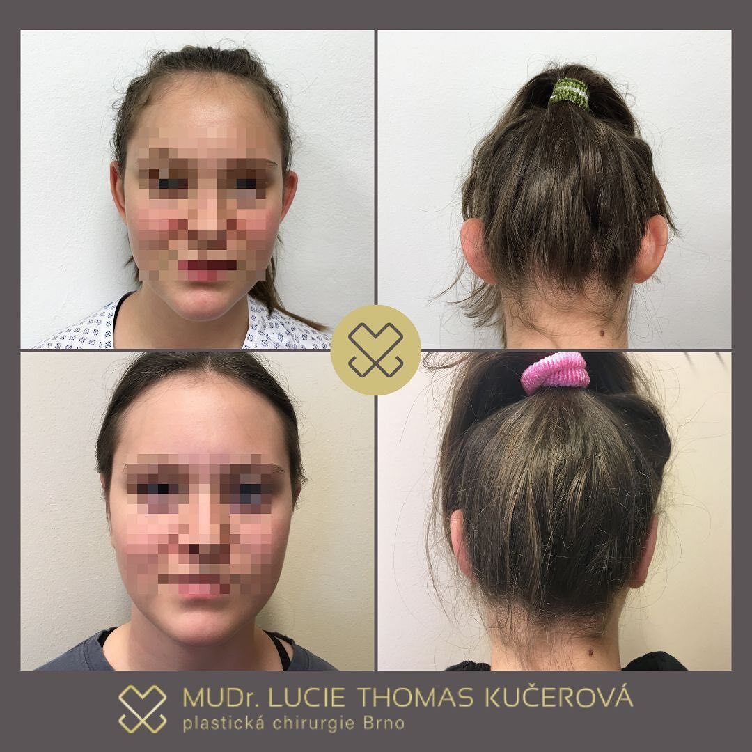Otoplastika: před a po - Estheticon.cz - Estheticon.cz