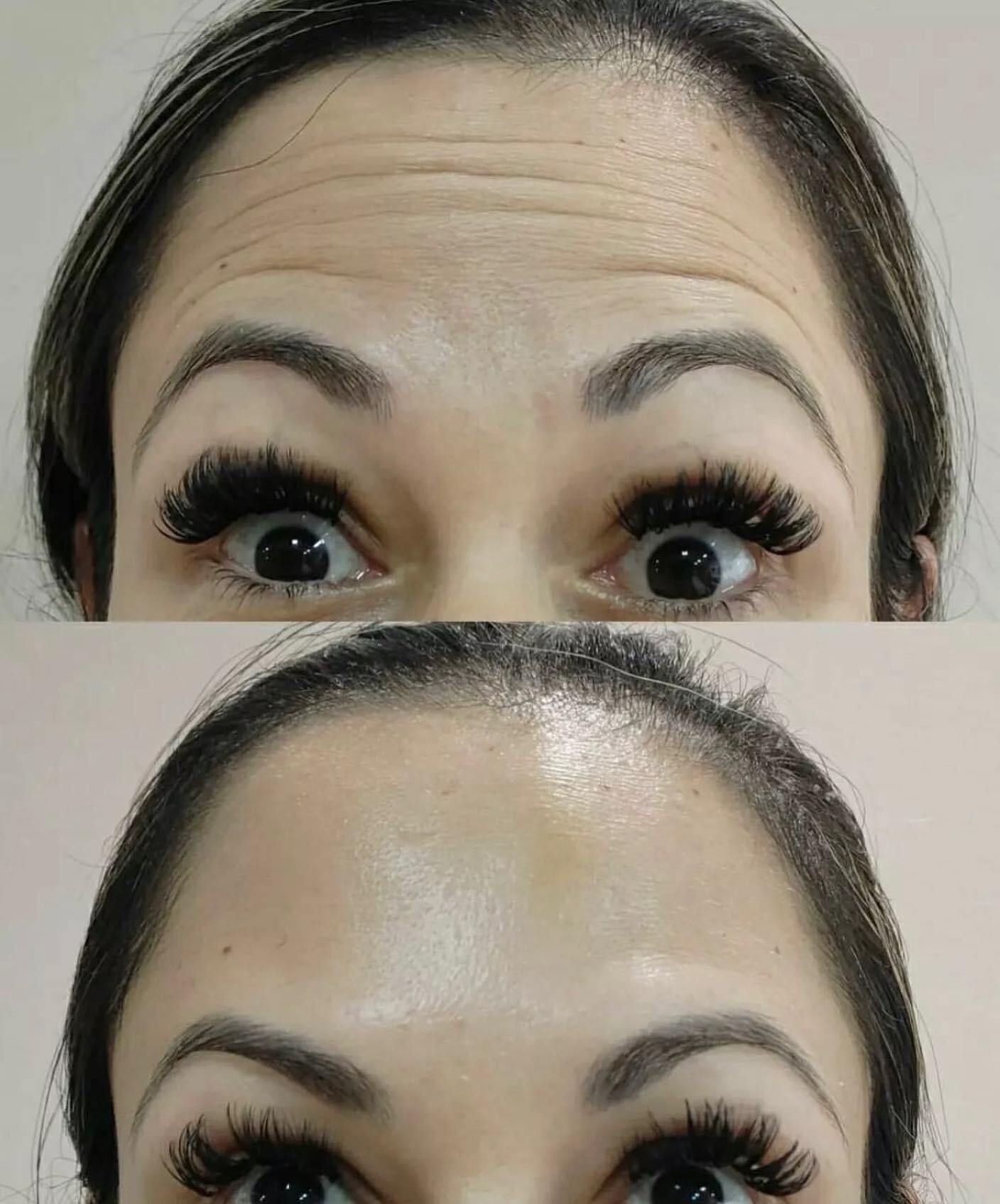 Botulotoxin: před a po - Estheticon.cz - Estheticon.cz