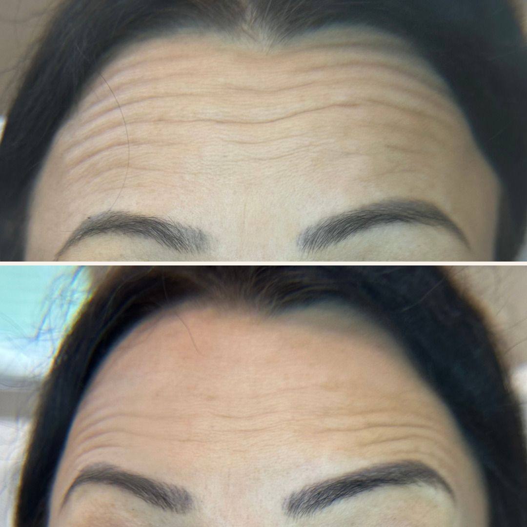 Botulotoxin: před a po - Estheticon.cz