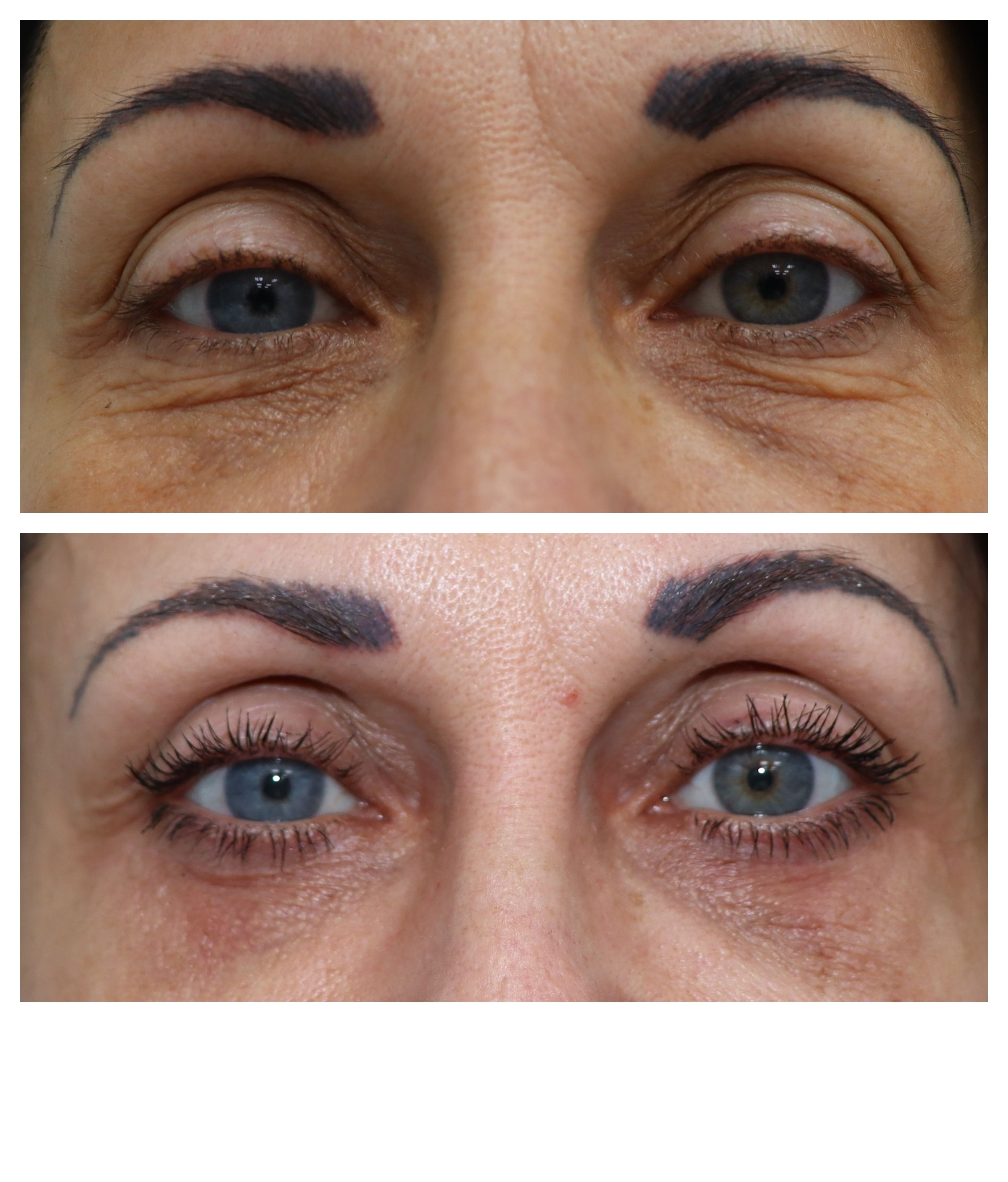 Operace dolních víček: před a po - Estheticon.cz - Estheticon.cz