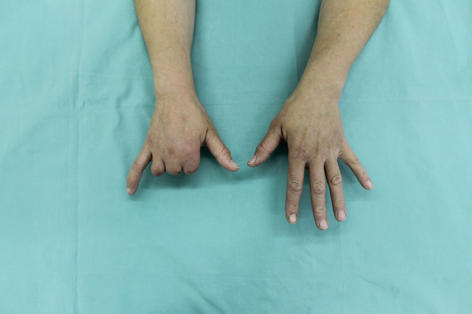 Přenos prstů na ruce - Chirurgie ruky - Estheticon.cz