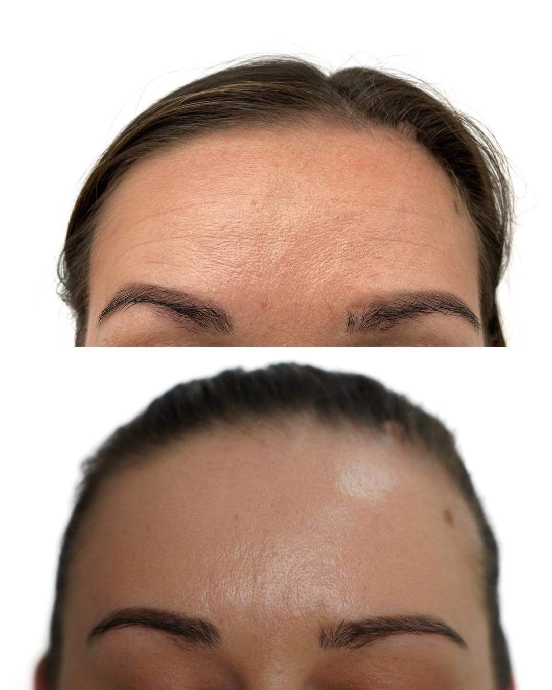 Podstúpila som zákrok výplň vrások - Botulotoxin - Estheticon.cz