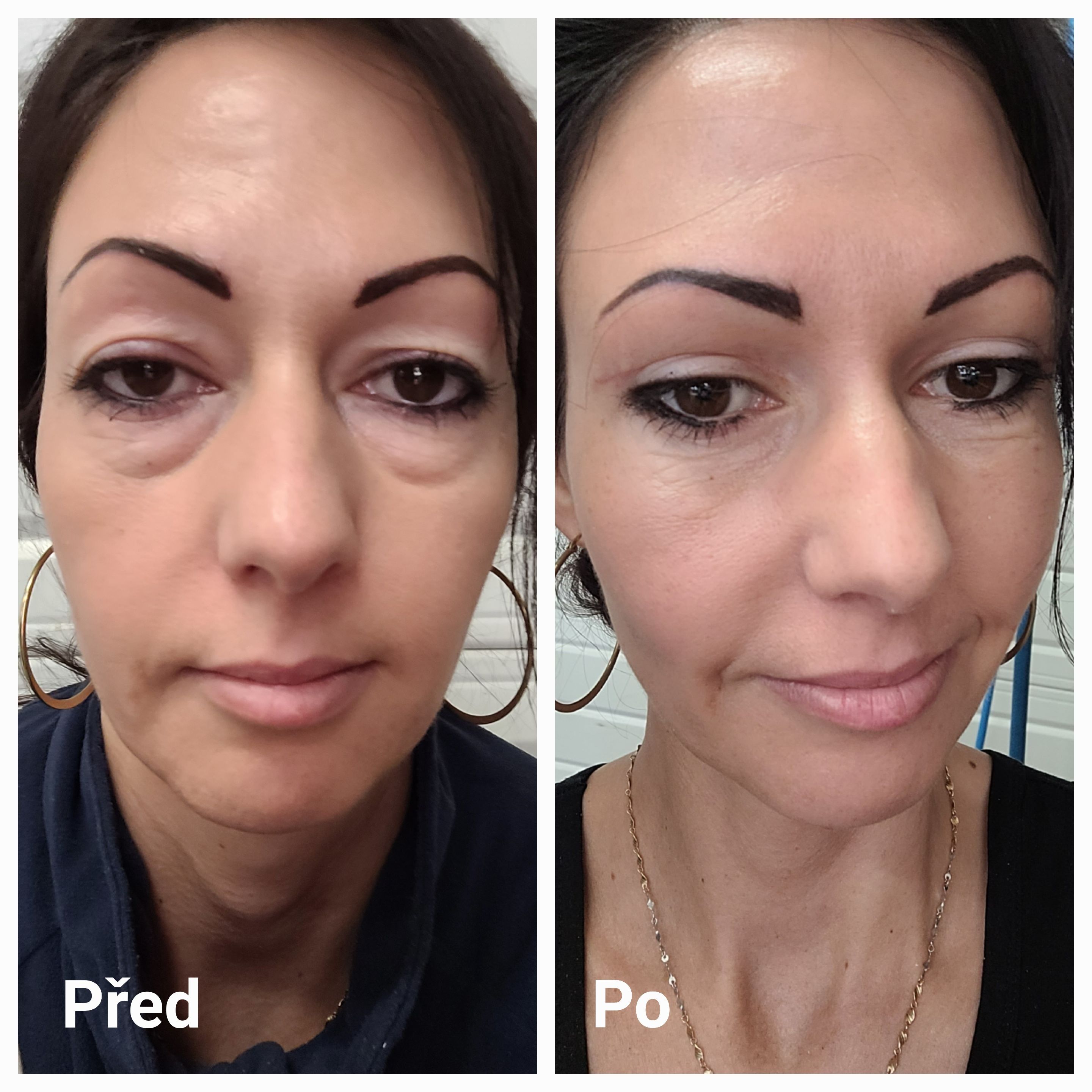 Dolní, horní víčka, MUDr Pavel Kurial - Operace očních víček ...