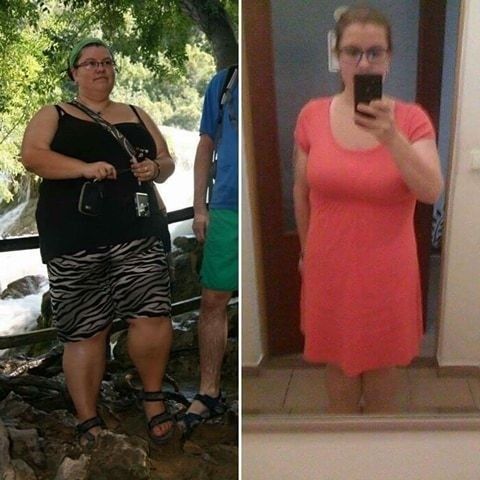 Převislé břicho, zhubnutí ze 150kg na 85kg - Abdominoplastika - Estheticon.cz