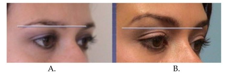 Temporal/ lateral brow lift - Estheticon.cz